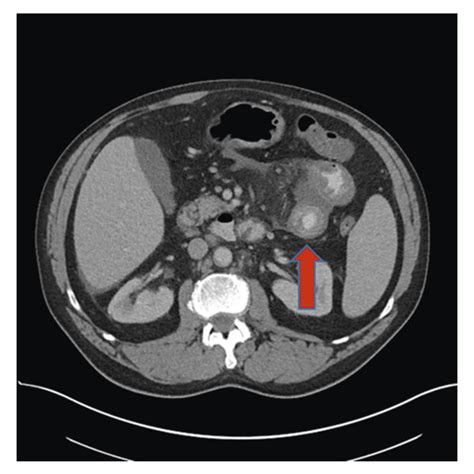 Ct Abdomen Findings Before And After Treatment A Before Treatment
