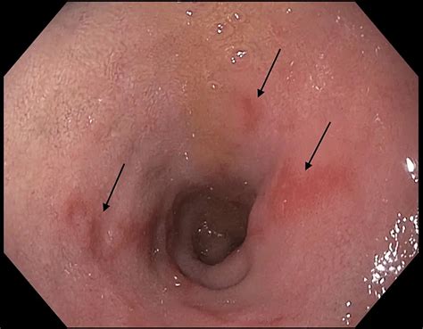 Duodenitis Causas Síntomas Y Tratamiento Doctor Online