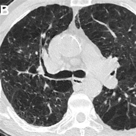 Pdf Emphysema And Bronchiectasis In Copd Patients With Previous Pulmonary Tuberculosis