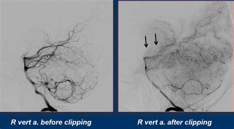 Anterior Choroidal Artery