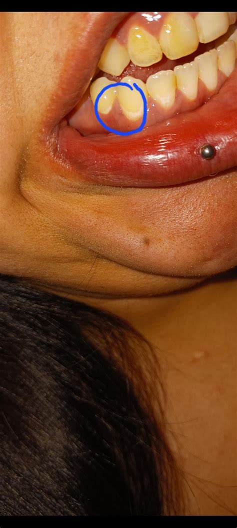 Is It An Abcess Or Part Of Inflammation Of My Gums R Dentalschool