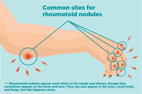What Are Rheumatoid Nodules
