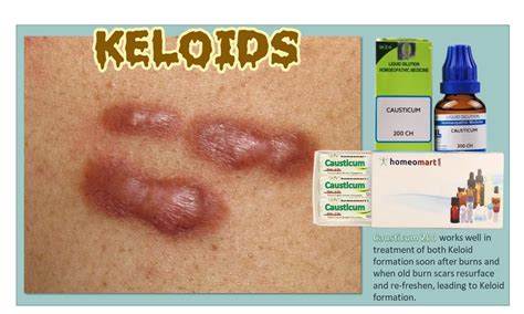 Best Homeopathic Remedies For Keloid Scars Dr Gopis Expert Solutions Homeomart