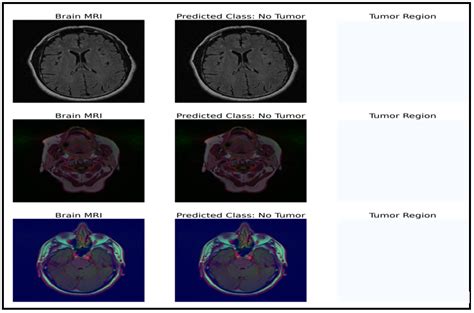 Brain Tumor Detection And Classification Using Fine Tuned Cnn With