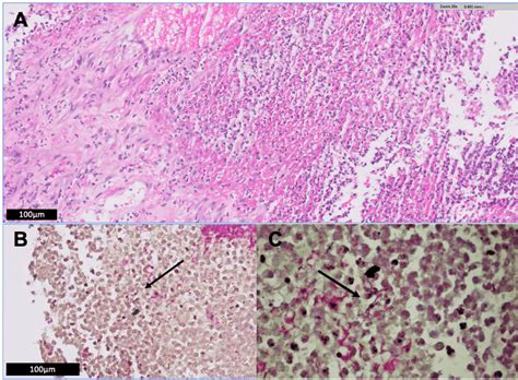 A Histologic Examination Of A Retroperitoneal Biopsy Specimen Download Scientific Diagram