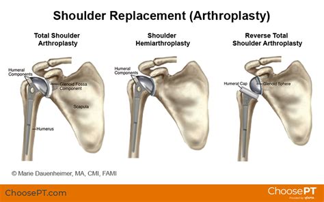 Dos And Donts For Shoulder Arthroplasty Surgery Results Shoulder