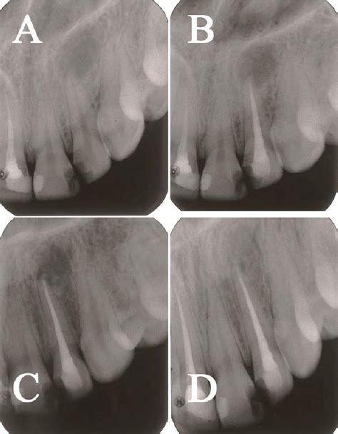 A Initial Radiograph Revealed Large Periapical Lesion B Radiograph