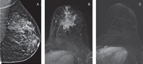 Breast Imaging Radiology Assistant At Matilda Howard Blog