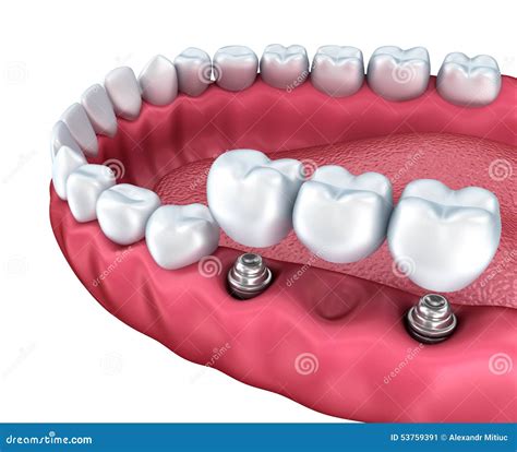 A Close Up View Of Lower Teeth And Dental Implants Stock Illustration