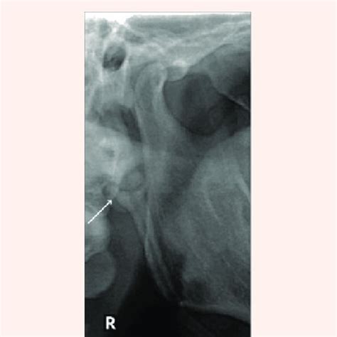 Type I Uninterrupted Elongated Styloid Process Radiograph From More