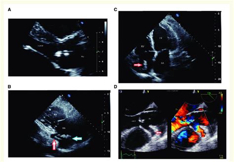 Echocardiography Demonstrating Aortic Valve Endocarditis Aortic