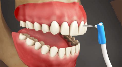 Patient Education Videos Dentistry On Bayview