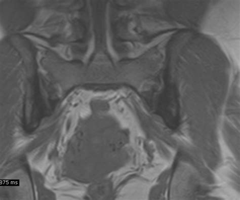 Osteitis Condensans Ilii Mri Sumers Radiology Blog