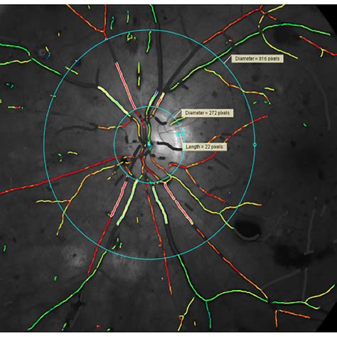 Retinal Oximetry And Peripheral Capillary Non Perfusion Results At