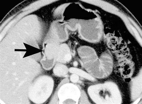 Brunner Gland Hyperplasia Duodenum Icd 10 At Marcus Glennie Blog