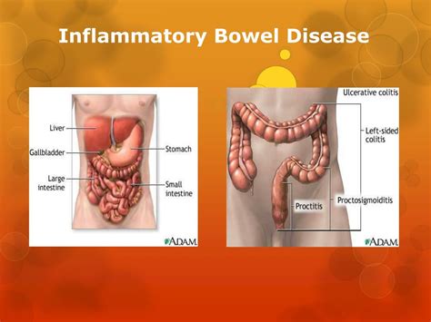 Ppt Crohns Disease Aka Regional Enteritis Powerpoint Presentation