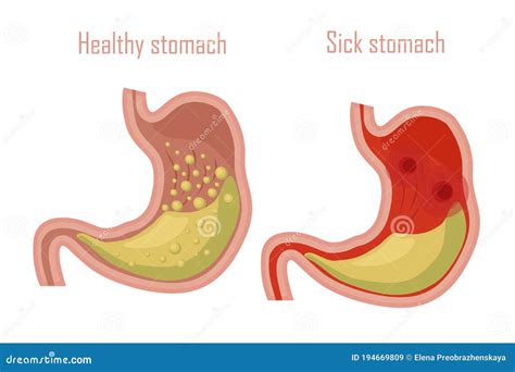 Human Stomach Digestive System A Healthy And Sick Stomach Vector Illustration Stock