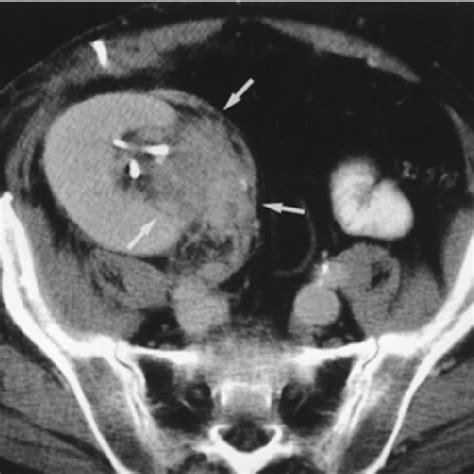 Pdf Post Transplant Lymphoproliferative Disorder A Clinical Perspective
