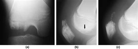 Osteochondrosis Of Primary Center Of Patella A Case Report Mskcqy