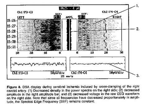 Eeg Monitoring Intraoperative Application Anesthesiology Clinics Of