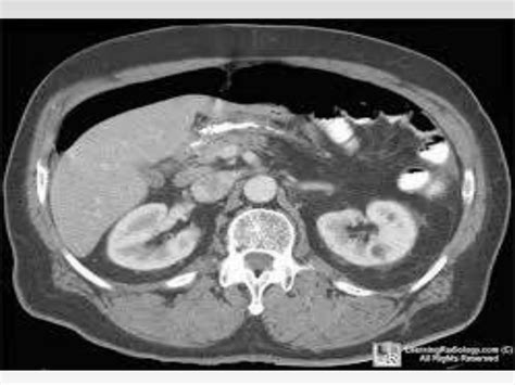 Perforated Peptic Ulcerpptx