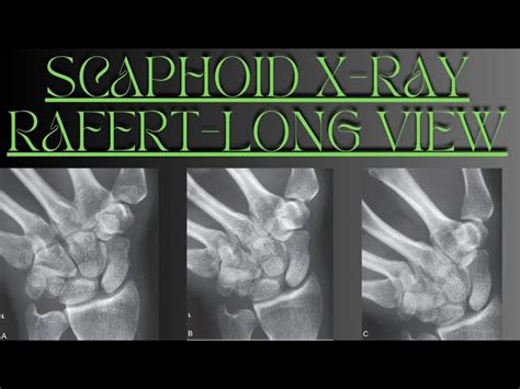 Scaphoid X Ray Angle