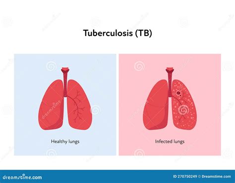 Tuberculosis Disease Concept Vector Flat Healthcare Illustration