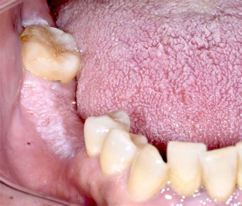Pathology Outlines Frictional Keratosis