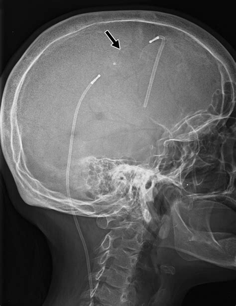 Imaging Evaluation Of Csf Shunts Ajr