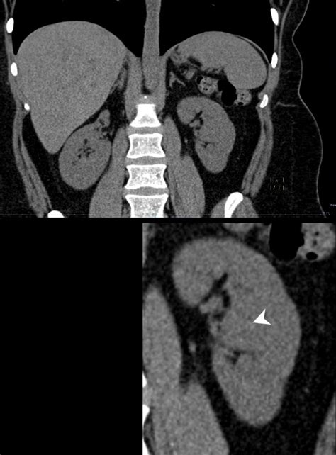 Column Of Bertin The Common Vein