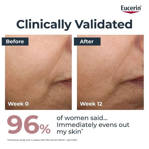 Melasma Causes Types And Effective Treatments Eucerin Uk