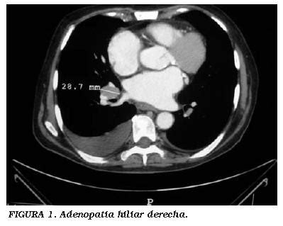 Adenopatías Mediastínicas En La Evolución De Un Cáncer De Próstata