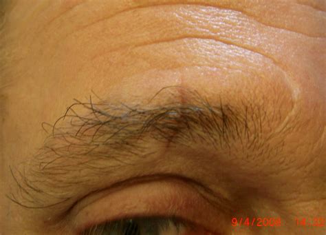 Bird Bite Photos Warning ~ Graphic Avian Avenue Parrot Forum