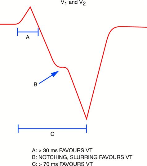Wide Qrs Complex Tachycardia