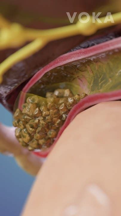 Liver Disease 3d Cholelithiasis Multiple Cholesterol Stones In Gallbladder Youtube