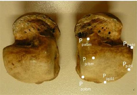 Anatomical Landmark Points On The Trochlear Surface Download