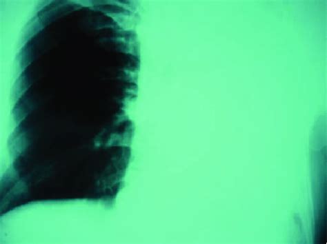 Atelectasis Of The Left Lung With Ipsilateral Shifting Of The