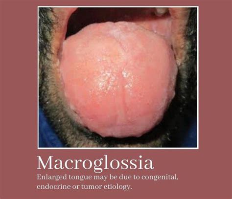 Macroglossia Medizzy
