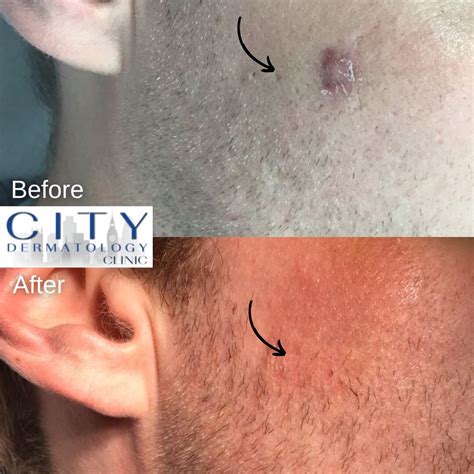 Cyst Removal In London Same Day Treatment From £295