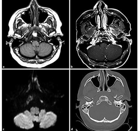 Case 1 Axial Pre Gadolinium A And Post Gadolinium B Images Show