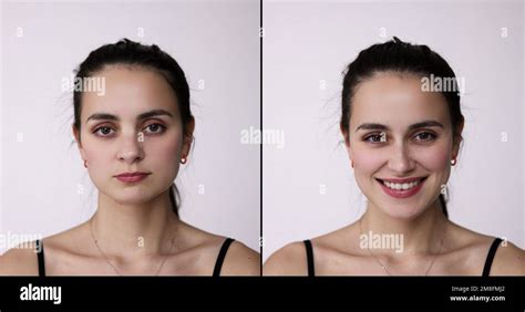 Before After Young Woman Aesthetic Facelift Rhinoplasty Nose And Mid
