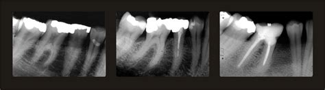 Periapical Reference Radiographs Left Sparse Trabeculation With Large Download Scientific