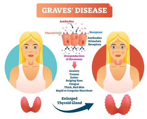 An Endocrinologist Talks About The Thyroid Gland And The Butterfly Effect Healthtoday