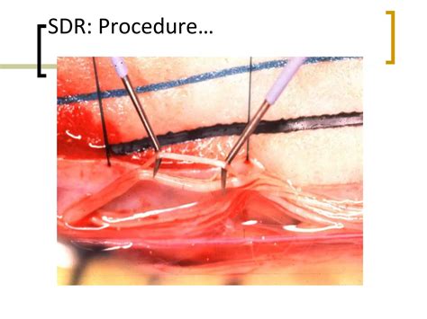 5 Spasticity Causes And Neurosurgical Management Pptx