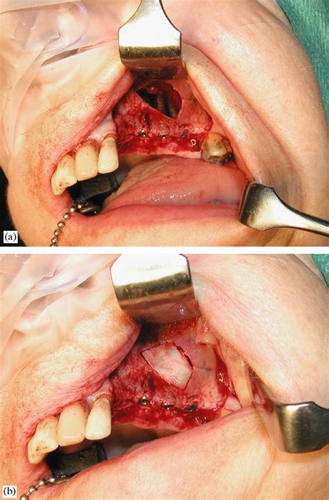 A And B Elevation Of The Maxillary Sinus Membrane And Simultaneous Download Scientific