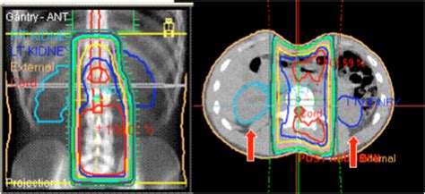 Radioterapia Conformada Tridimensional 3d Oncolink