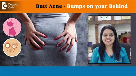 Butt Acne Acne Bumps On Your Back Causes And Treatment Dr Urmila Nischal Doctors Circle