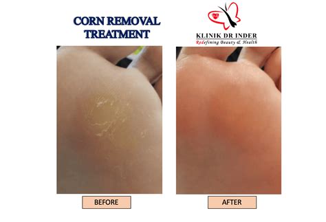 Corn Removal Laser Treatment Aesthetic Clinic Klinik Dr Inder