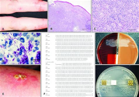 A Erythematous Papules And Indurated Nodules On Both Lower Legs B