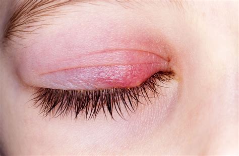 What Causes Recurring Styes Camarillo